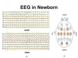 Convulsion and neonatal hyperthermia | PPTX