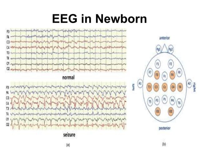 Convulsion and neonatal hyperthermia | PPTX | Pregnancy | Reproductive ...