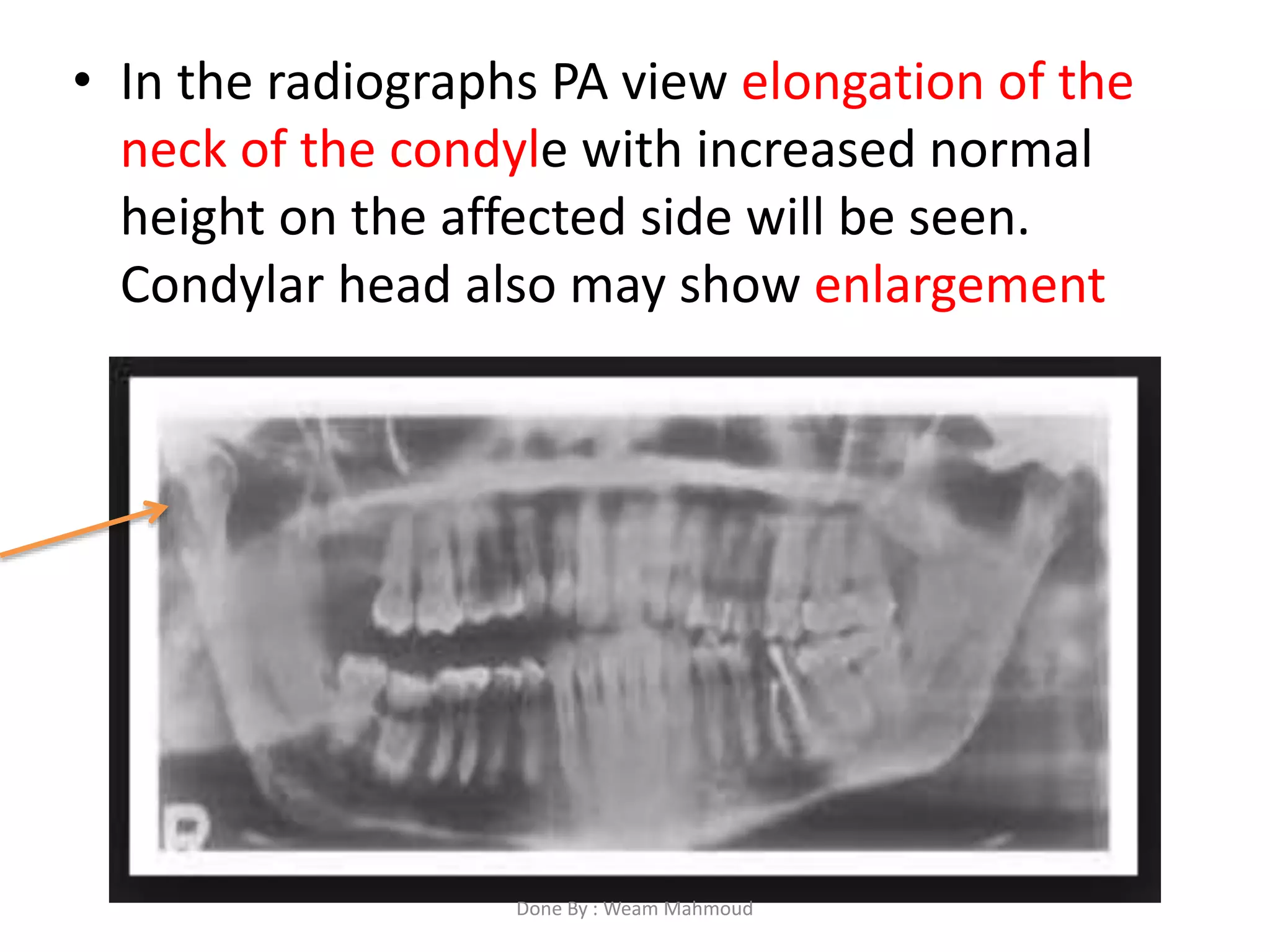 Conylar hyperplasia | PPSX