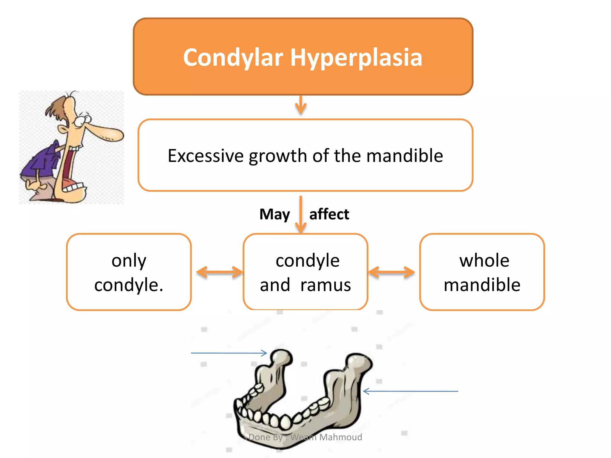 Conylar hyperplasia | PPSX