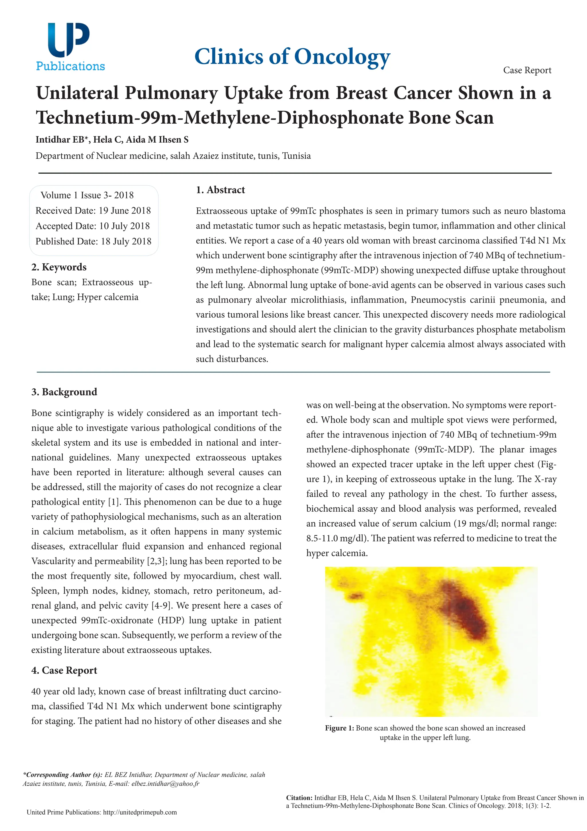 Unilateral Pulmonary Uptake from Breast Cancer Shown in a Technetium ...