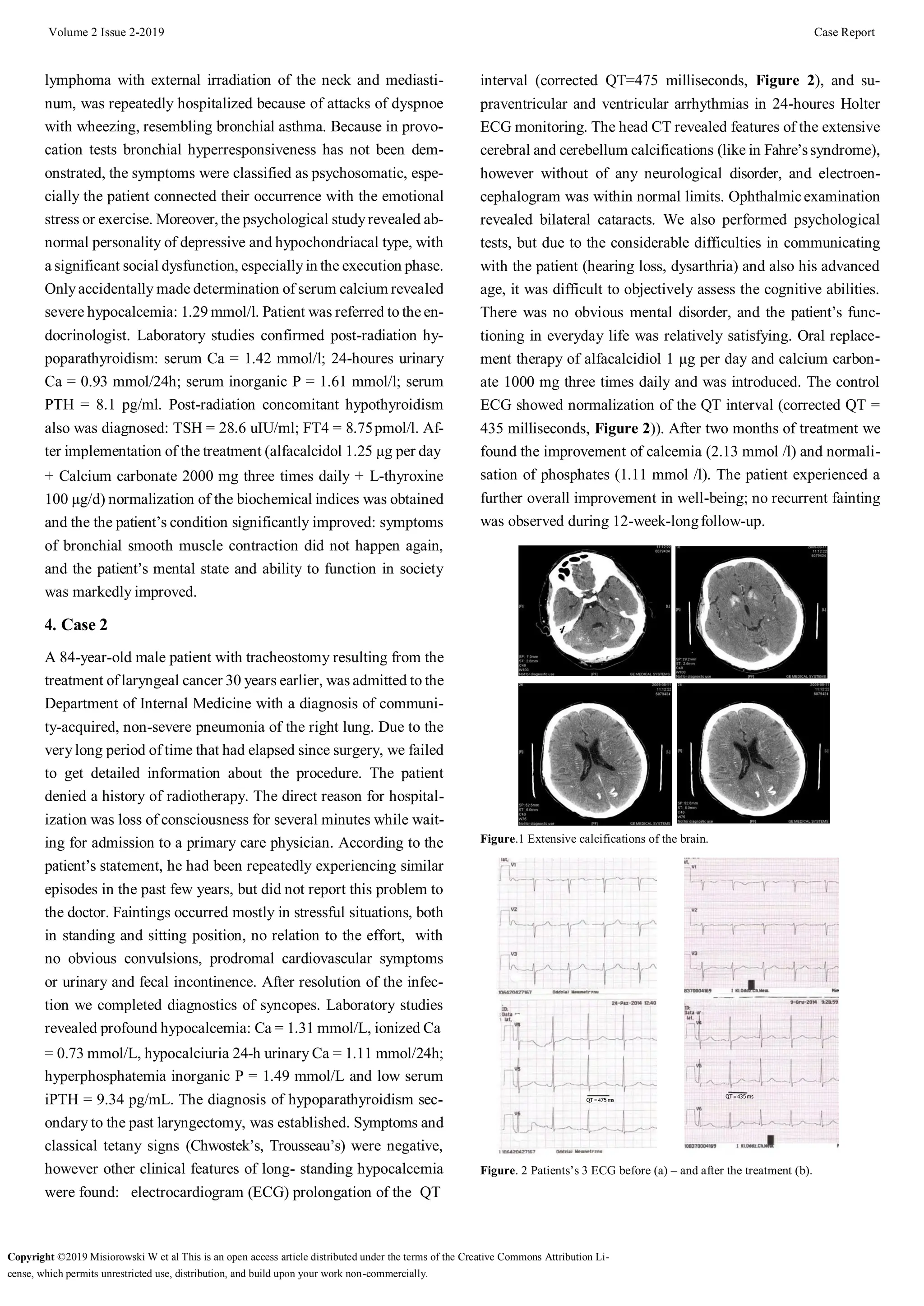 Hypoparathyroidism - Not Only after StrumectomyUnusual Presentations of ...
