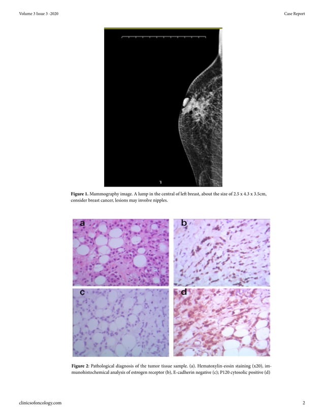 A Patient with Gastric Metastasis of Lobular Breast Cancer with CDH1 Mutation: A Case Report