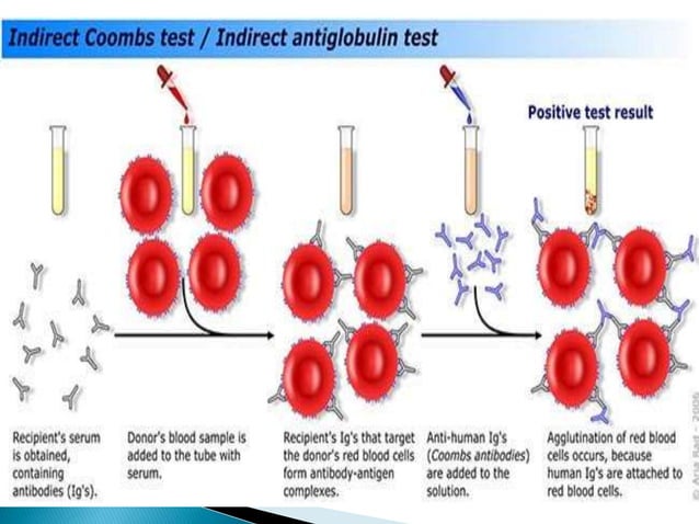 Coomb's test | PPTX | Blood Disorders | Diseases and Conditions