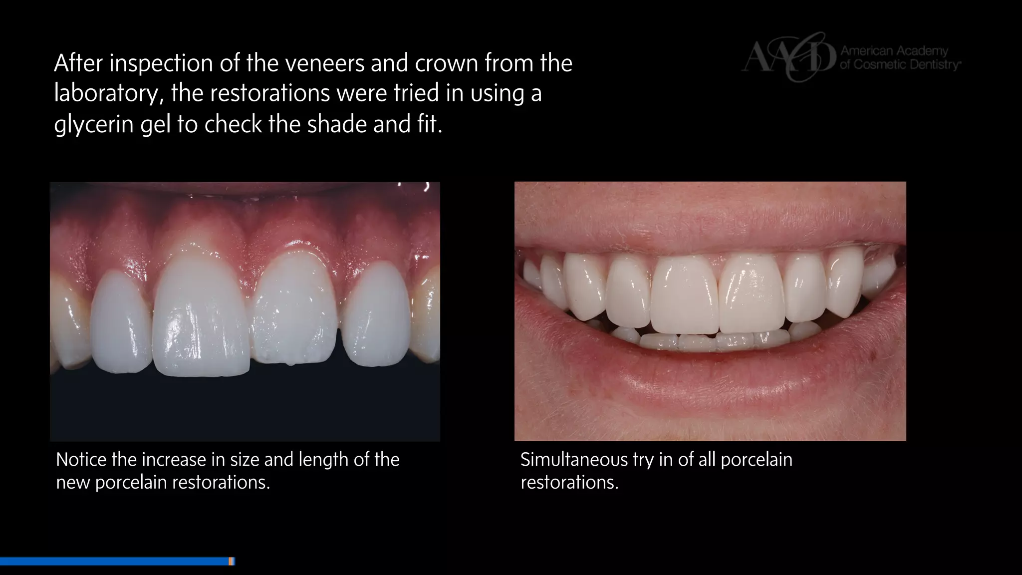 Ultraconservative Dentistry Using "No-Prep" Porcelain Veneers | PDF