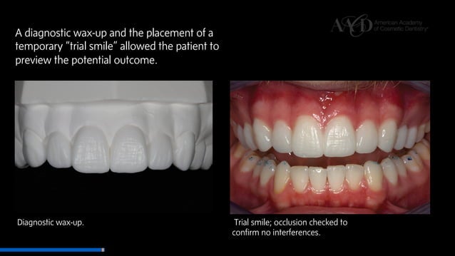 Ultraconservative Dentistry Using "No-Prep" Porcelain Veneers | PPT