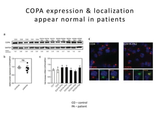 COPA mutations impair Golgi-ER transport causing hereditary autoimmune ...