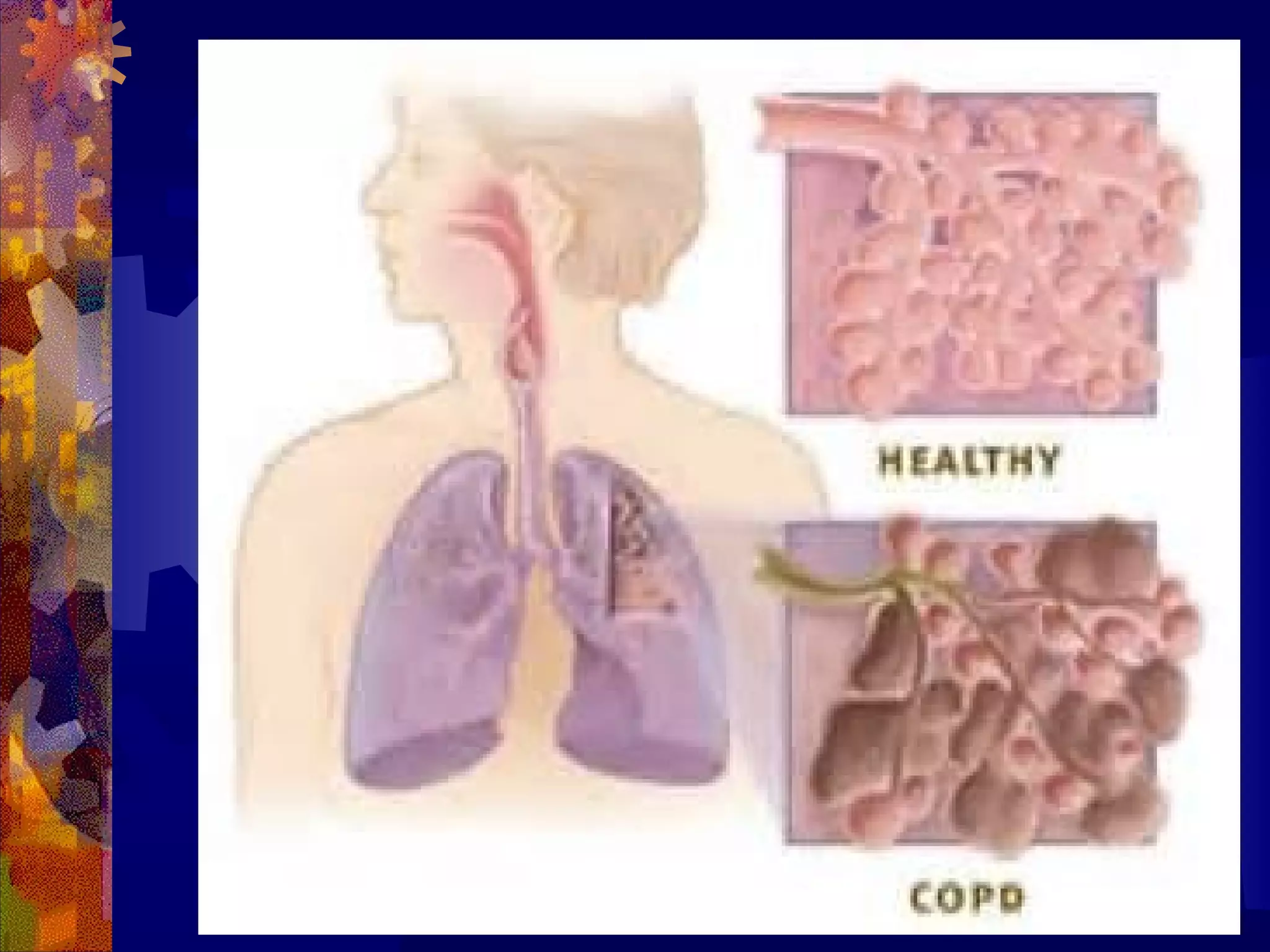 Copd | PPT