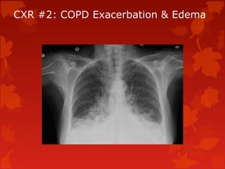Copd | PPT