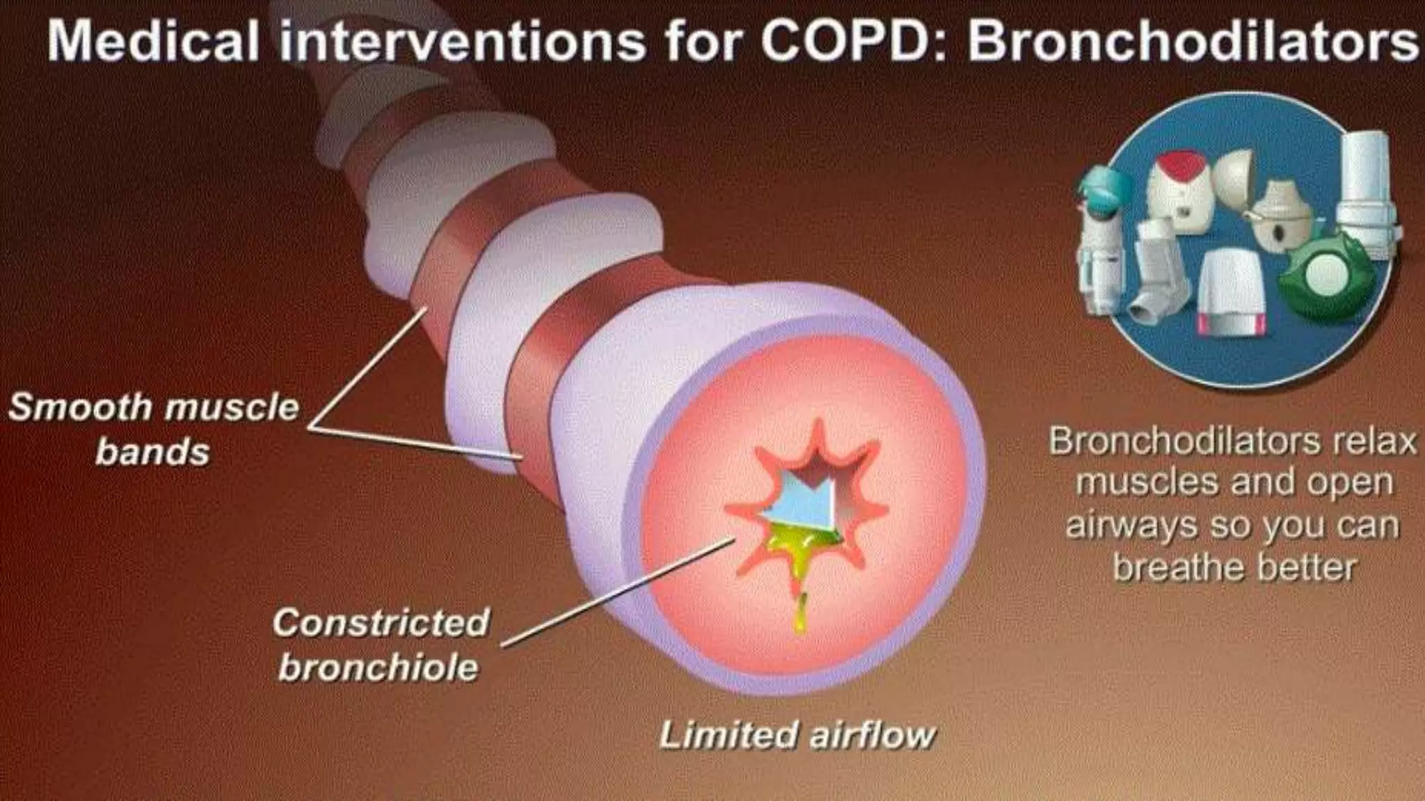 COPD (CHRONIC PULMONARY OBSTRUCTIVE DISEASE) by SUKHERA | PPTX