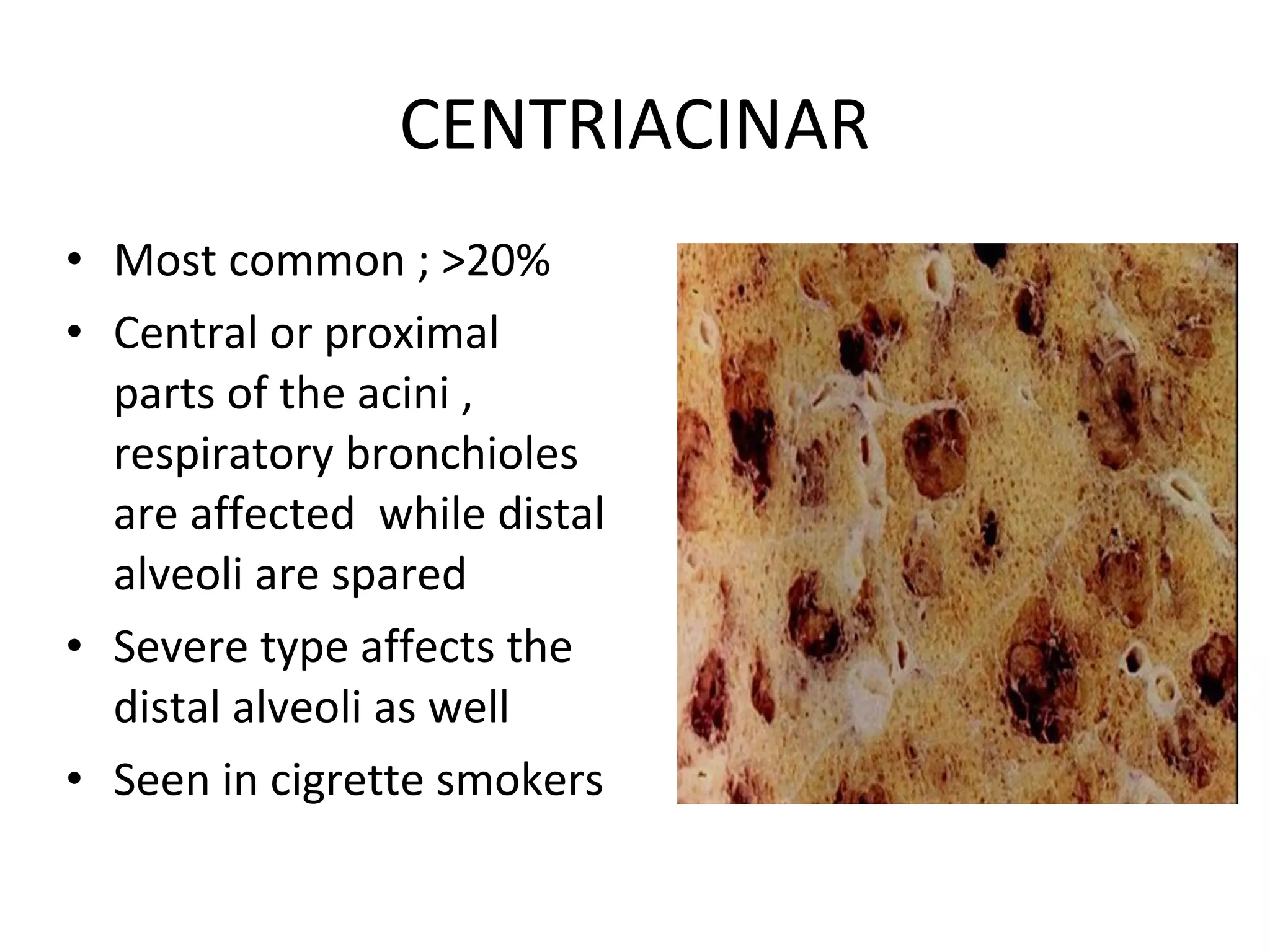 COPD | PPT