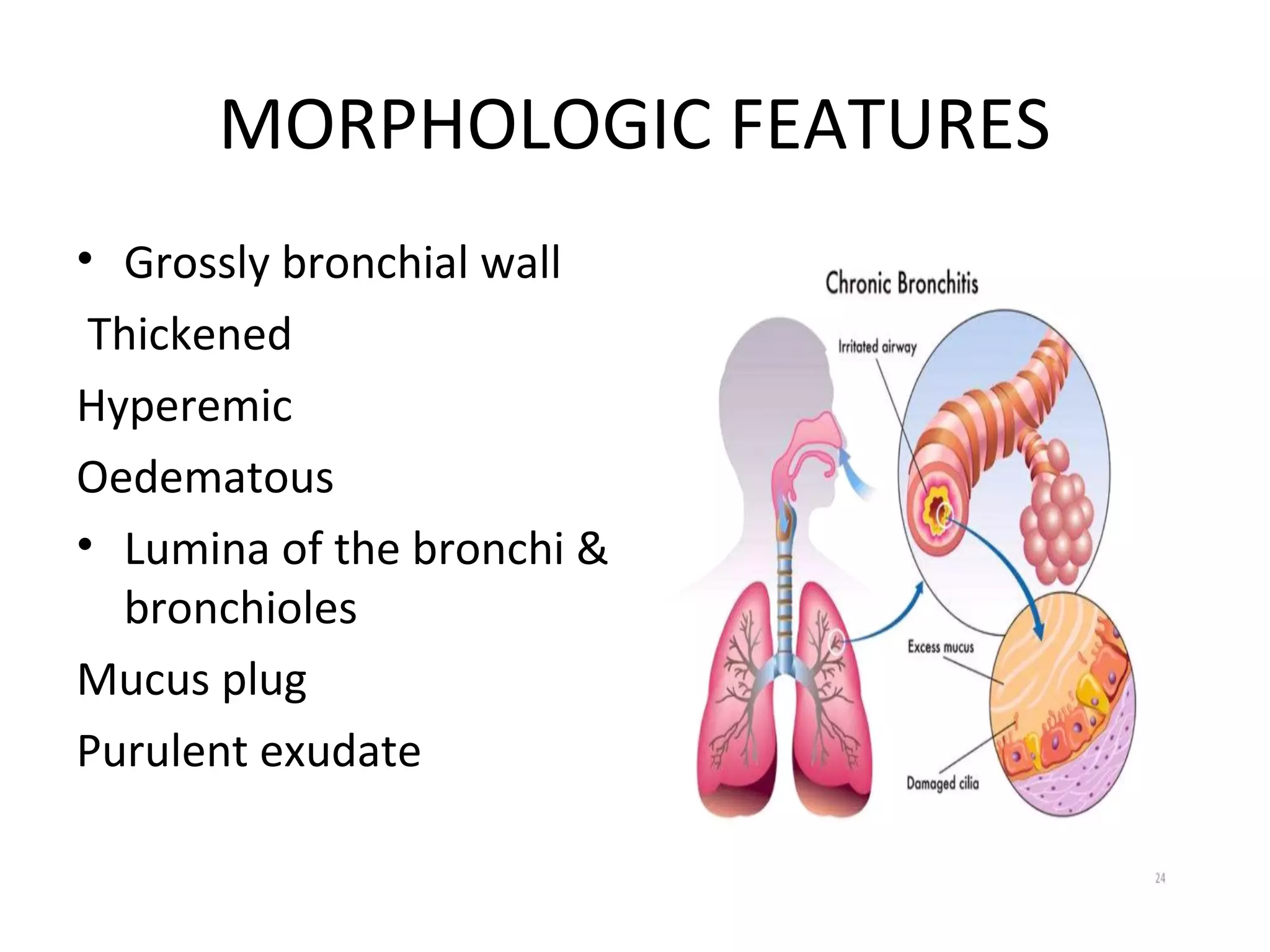 COPD | PPT