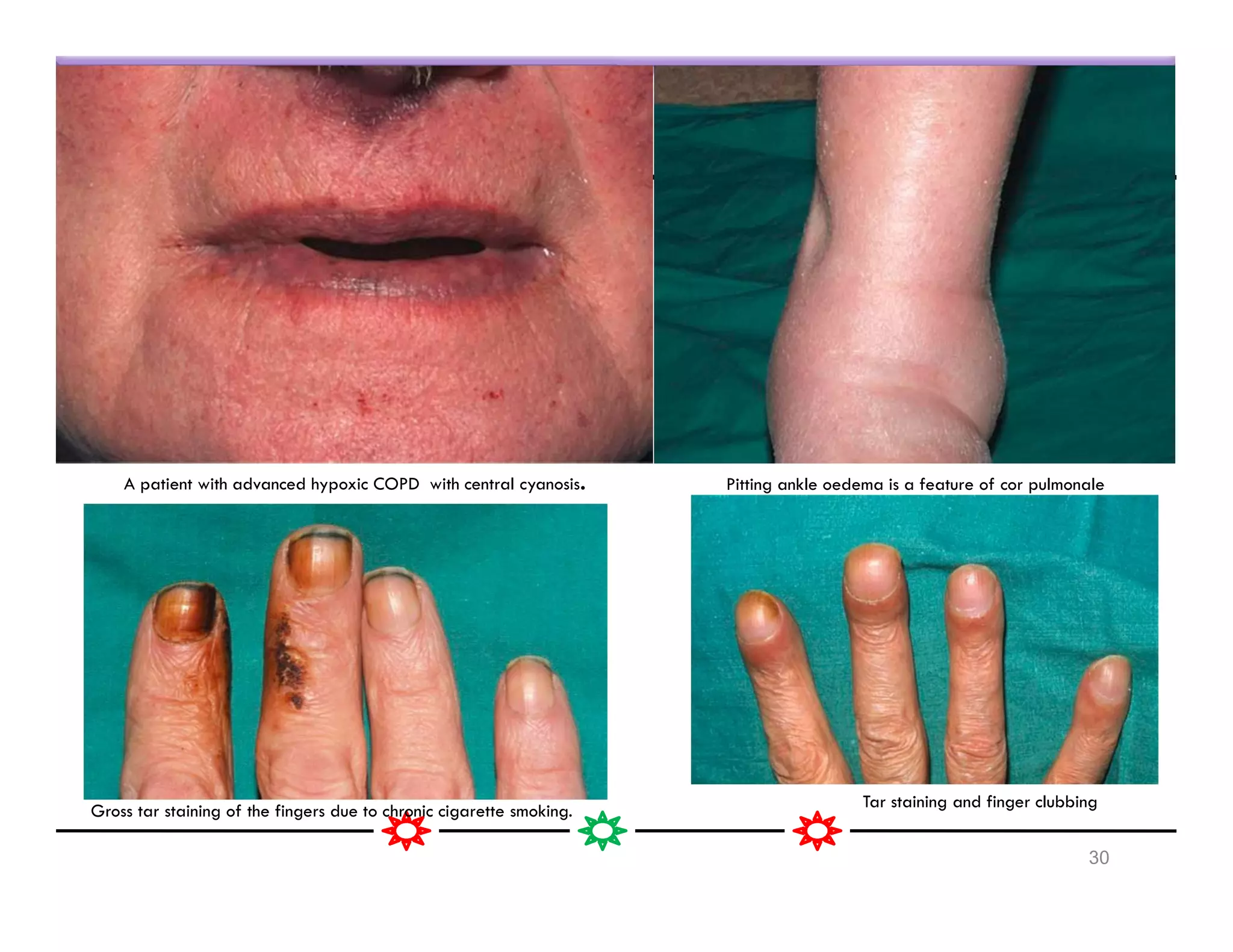 Pharmacotherapy of Chronic Obstructive Pulmonary Disease | PDF
