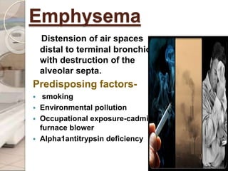 COPD | PPT