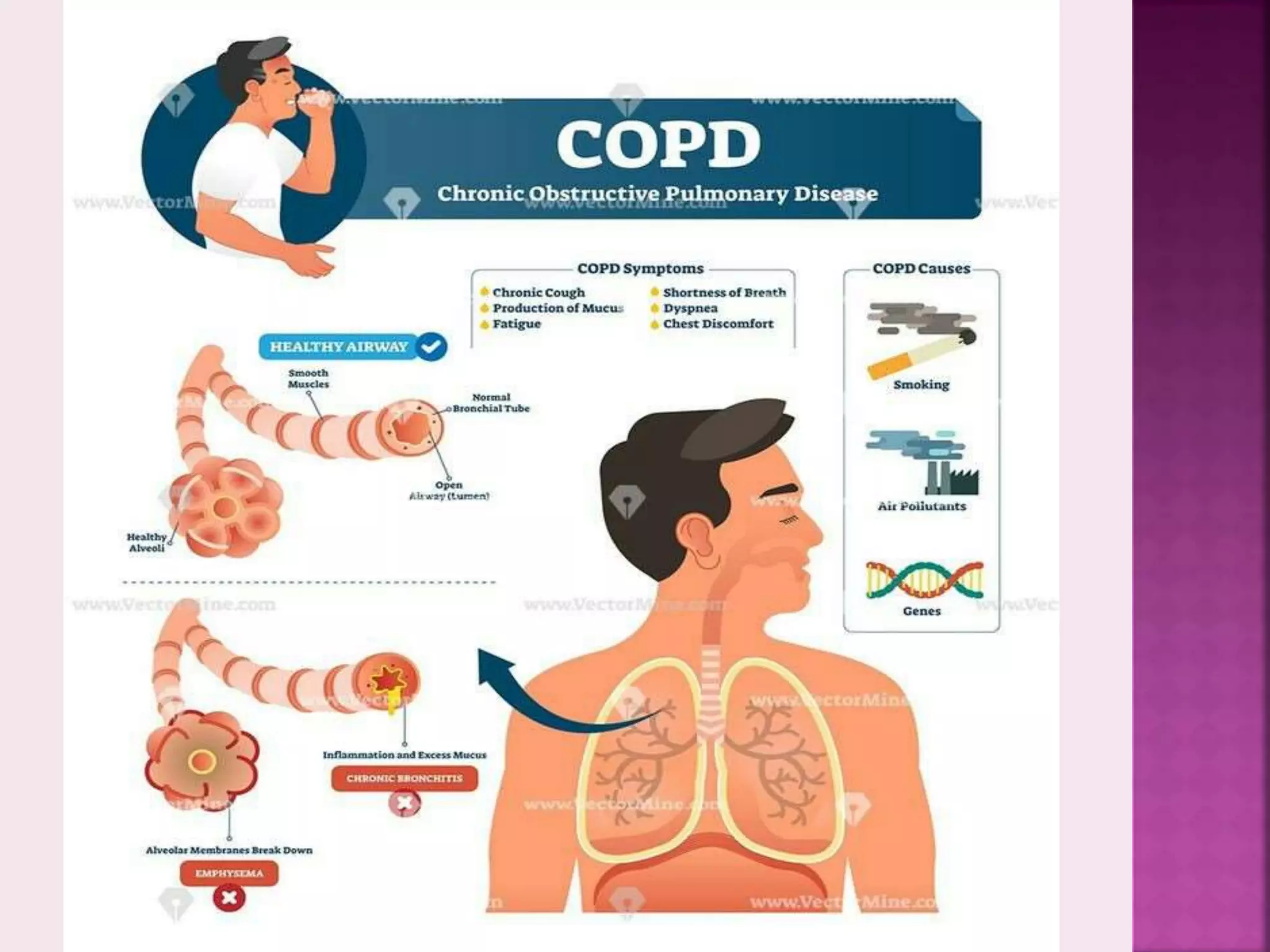 Copd | PPTX
