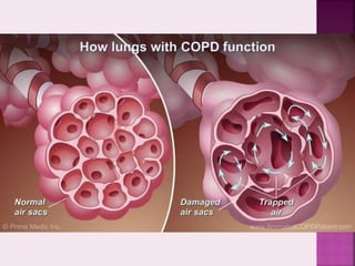 Copd | PPTX