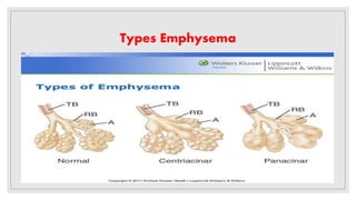 CHRONIC OBSTRUCTIVE PULMONARY DISEASE (COPD) | PPTX