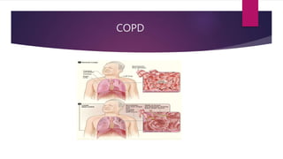 Copd. pptx | PPTX