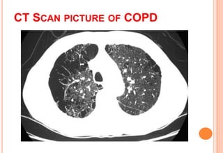 Chronic obstructive pulmonary diseases & Nursing care. | PPTX