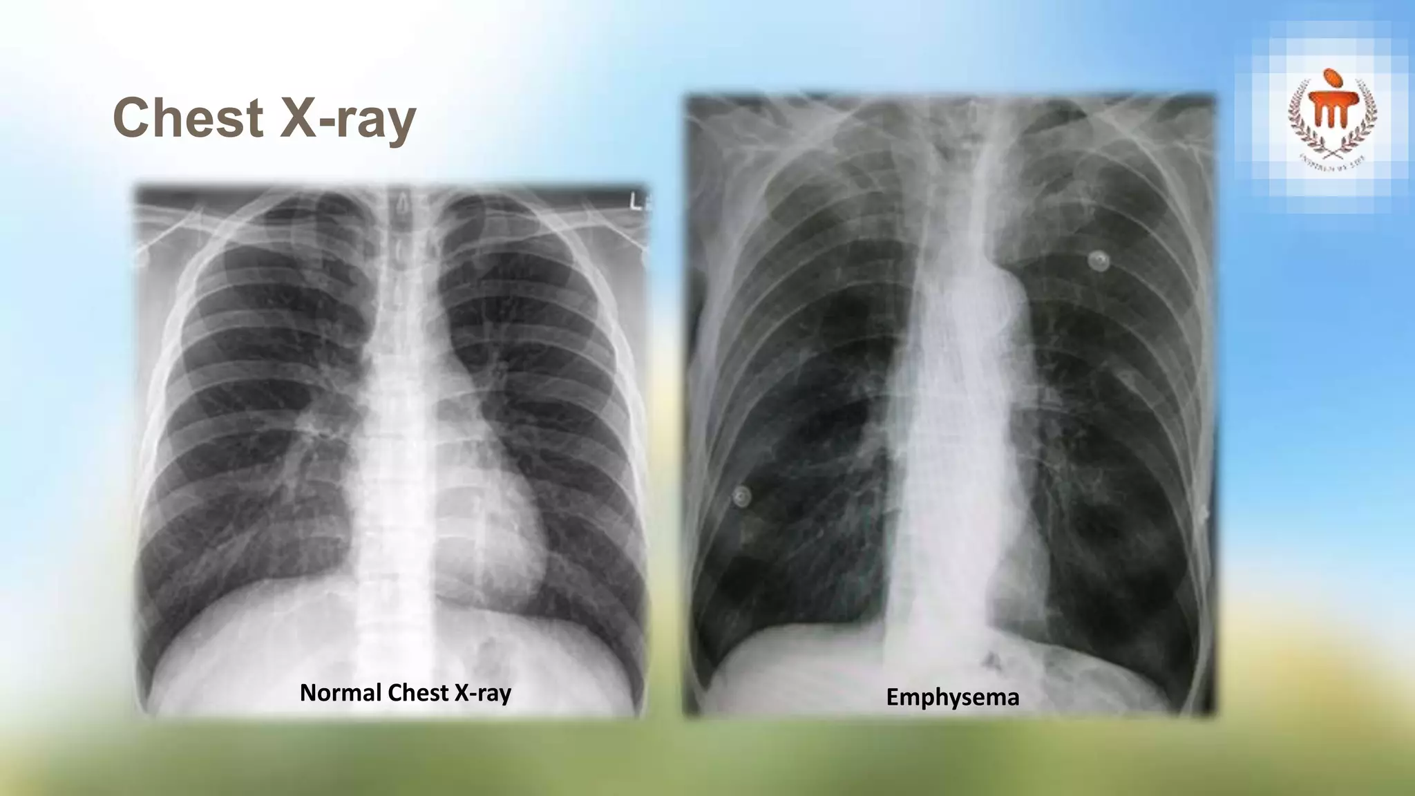 COPD - Chronic Obstructive Pulmonary Disease | PPTX