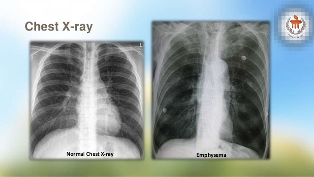 Copd Lungs X Ray