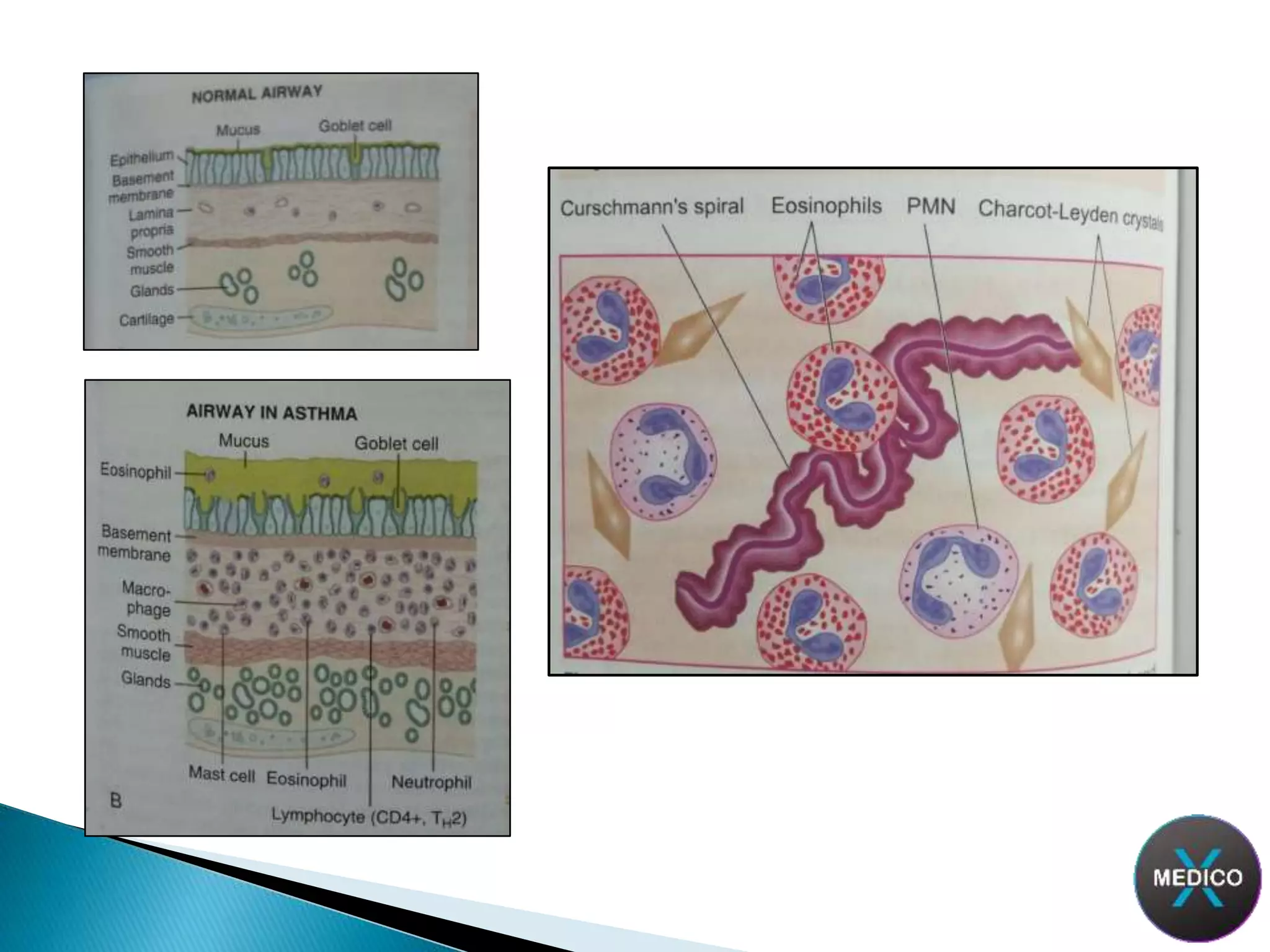 COPD - Chronic Obstructive Pulmonary Disease |medico X| Pathology | PPT