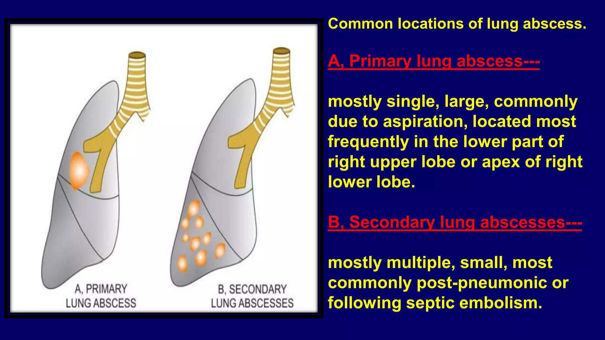 LUNG ABSCESS | PPTX
