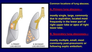 LUNG ABSCESS | PPTX