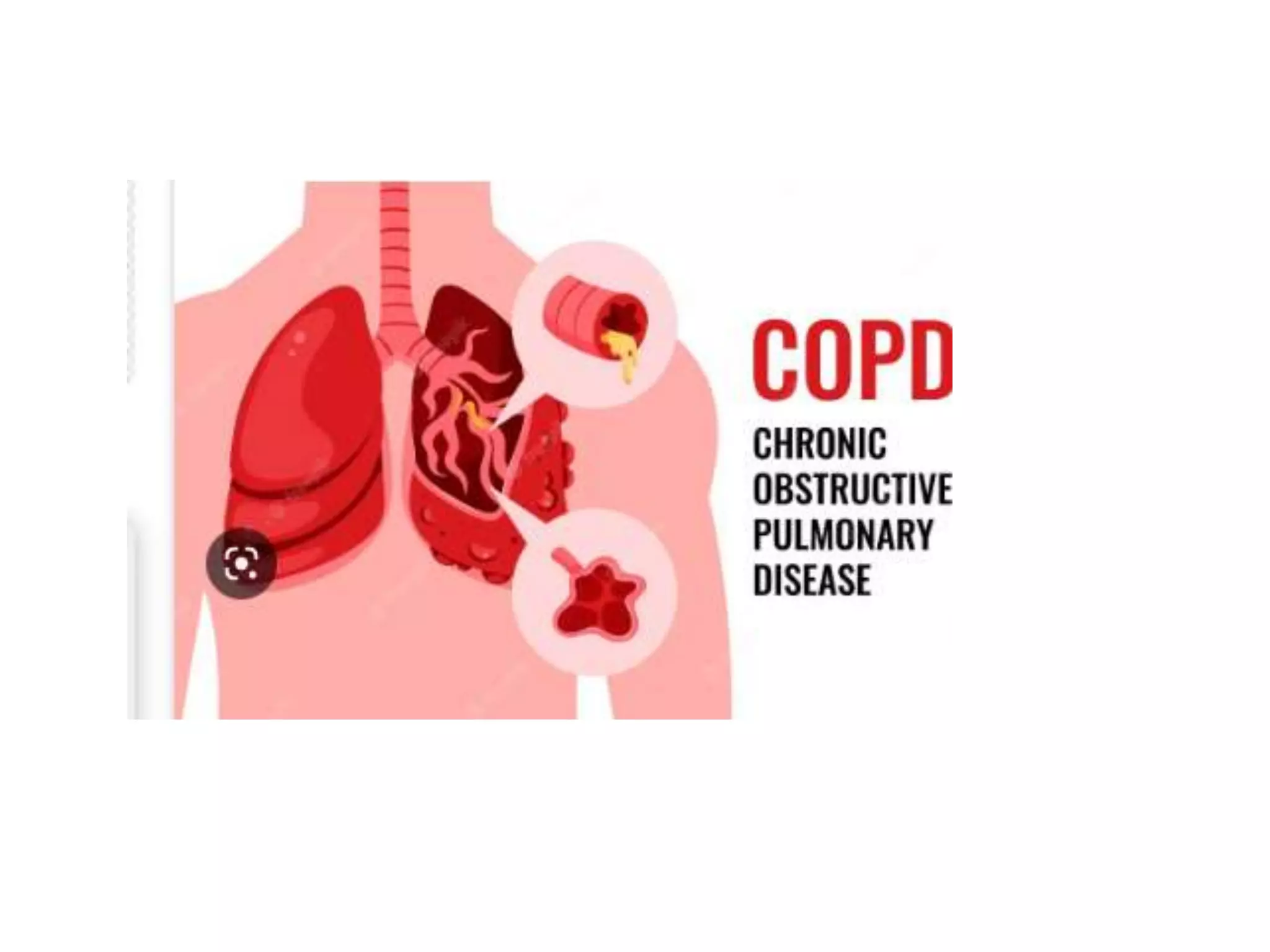 COPD.pptx | Lung and Respiratory Health | Diseases and Conditions