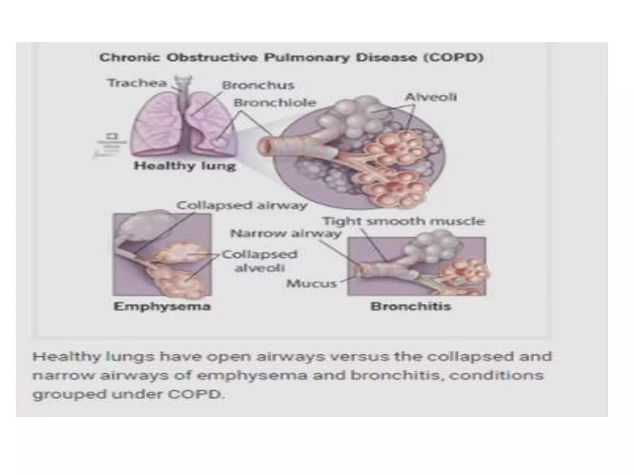 COPD.pptx