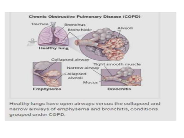 COPD.pptx | Lung and Respiratory Health | Diseases and Conditions