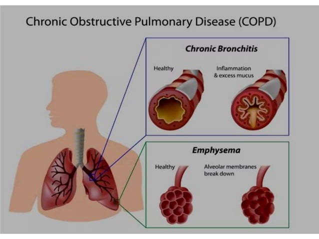 COPD.pptx | Lung and Respiratory Health | Diseases and Conditions