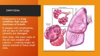 COPD.pdf