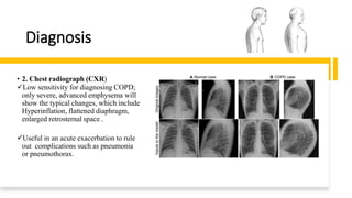 COPD.pptx