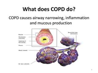 CHRONIC OBSTRUCTIVE PULMONARY DISEASE(COPD).pptx