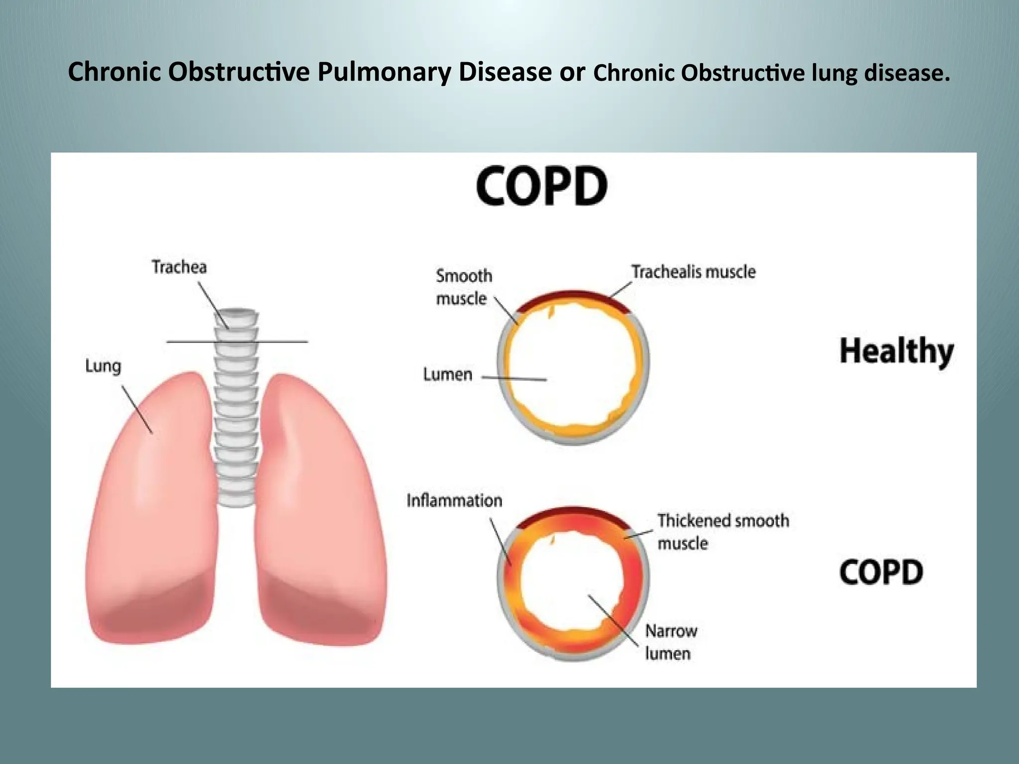 Chronic obstructive pulmonary disease in MSN I | PPTX