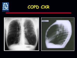 Mechanical Ventilation of Patients with COPD and Asthma | PPT