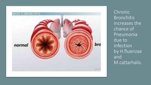 COPD -MA.pptx