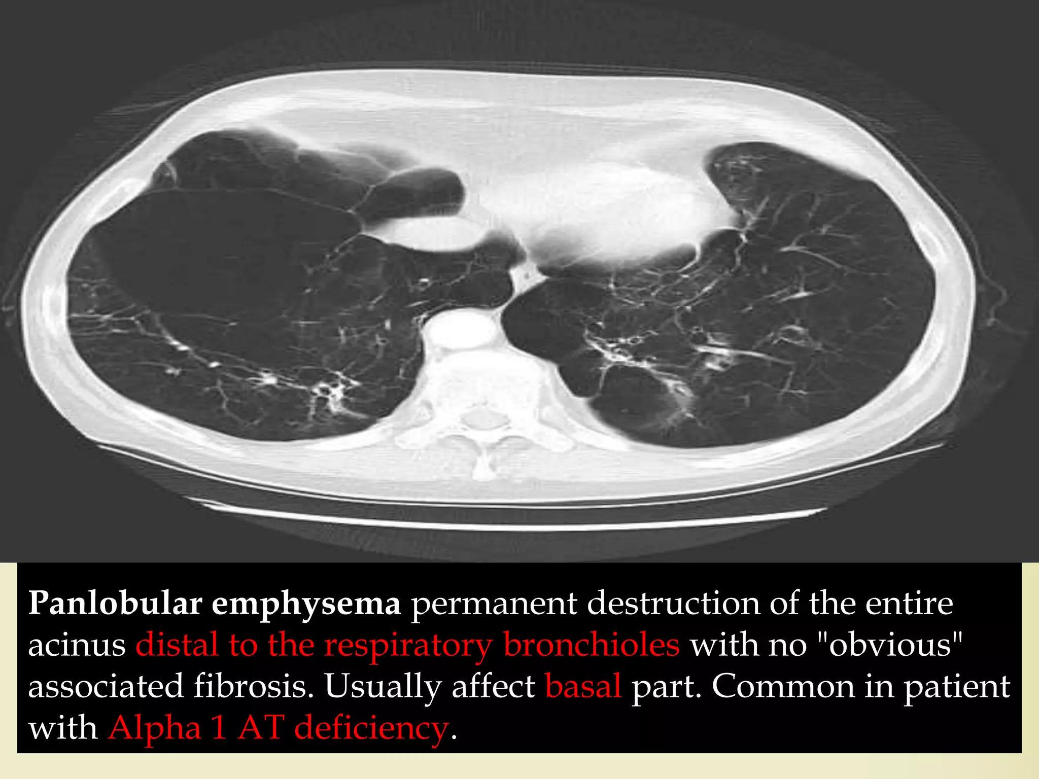 COPD overview and update | PPTX