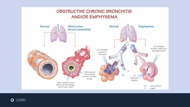 COPD-Report.pdf