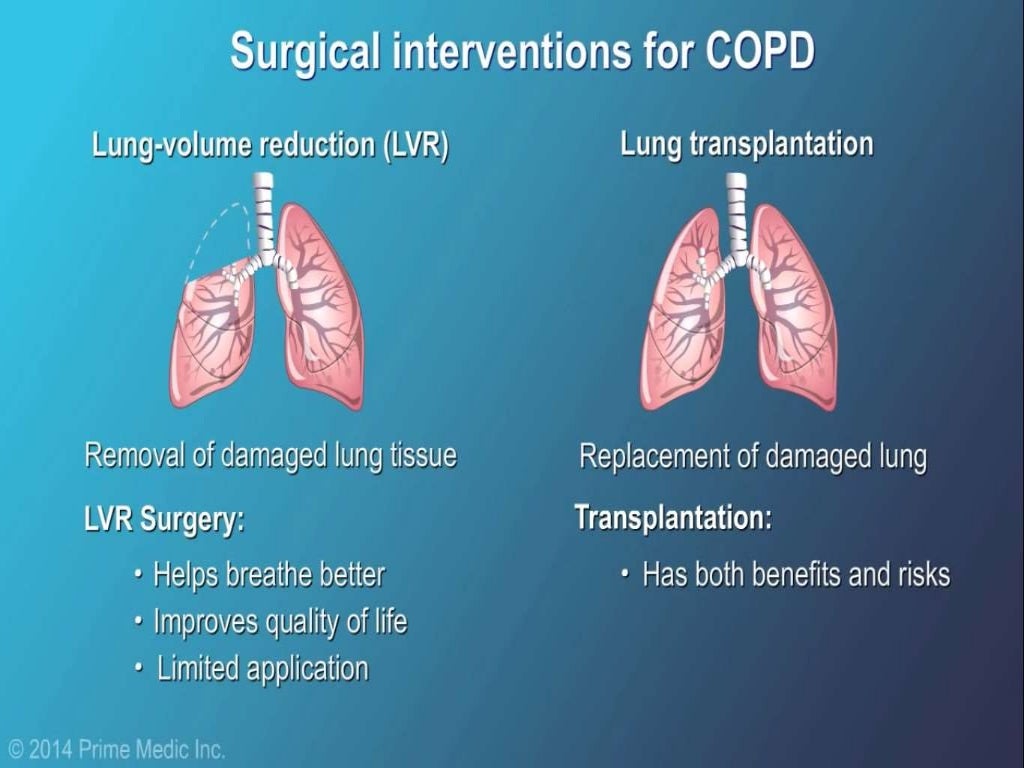 CODP ( Chronic Obstructive Pulmonary Disease )