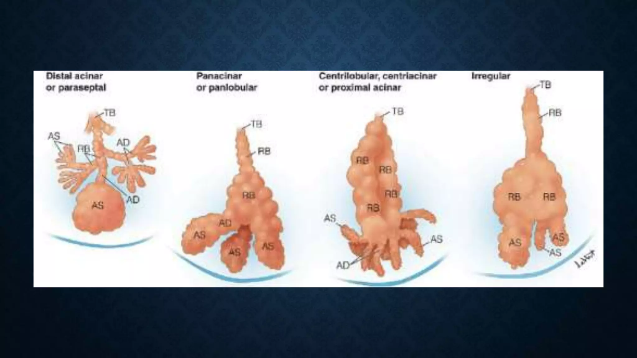 COPD Teaching Slides for UGs | PPTX