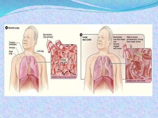 Copd and ards | PPTX