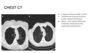 COPD and GOLD guidelines and management.pptx