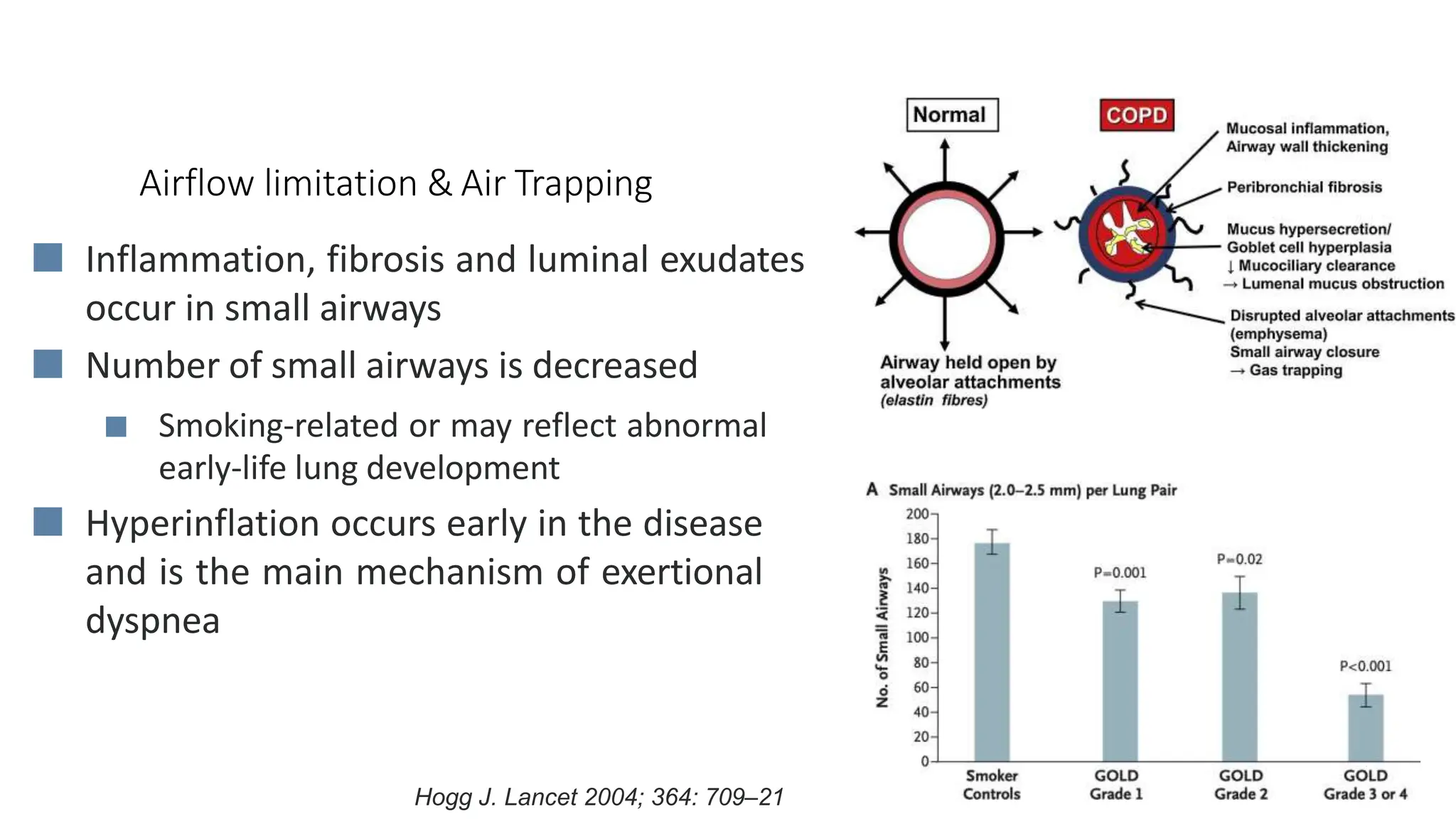 COPD CHEST.pptx