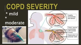 COPD DAY 2020 Ph | PPT