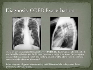 Copd exacerbation | PPTX