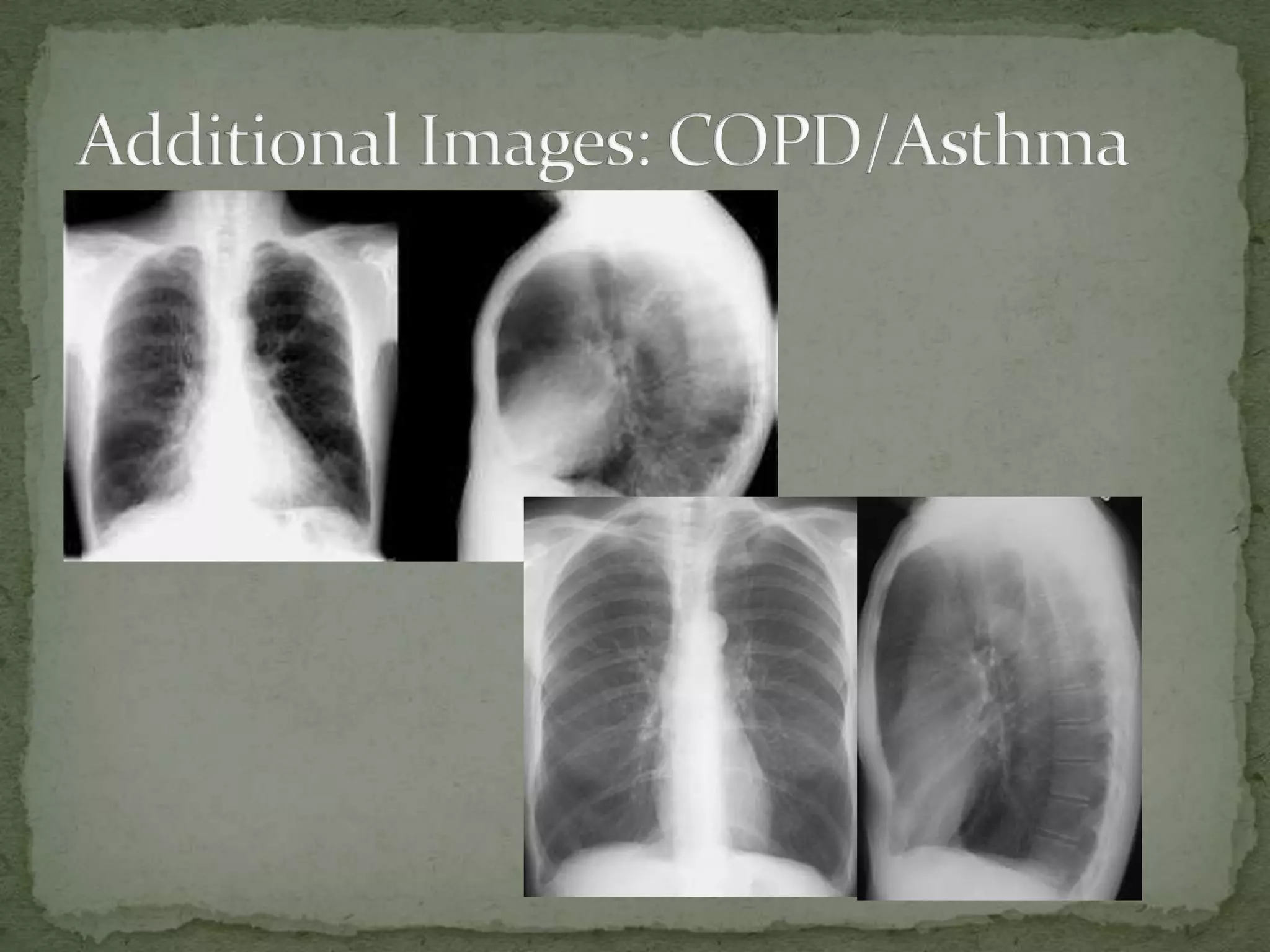 Copd exacerbation | PPTX