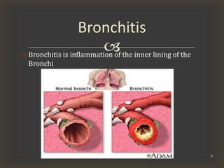 Chrnonic Obstructive Pulomonary Disease - Pathophysiology | PPTX