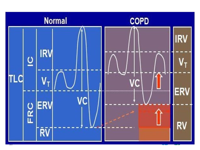 ABC of COPD 2017 | PPT